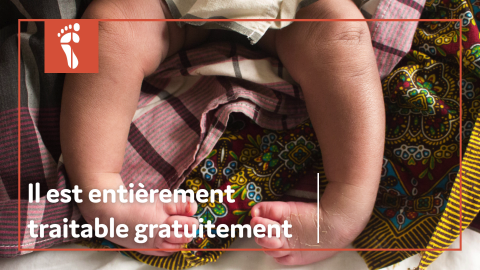 Le pied bot est une anomalie congénitale courante, il est entièrement ...